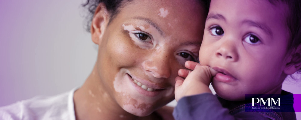 انواع لک‌های پوستی و راه‌های پیشگیری از آن‌ها - PMLM